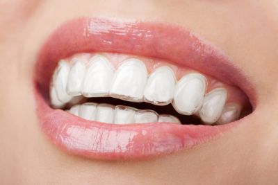 Type of Braces - Overleigh Orthodontics